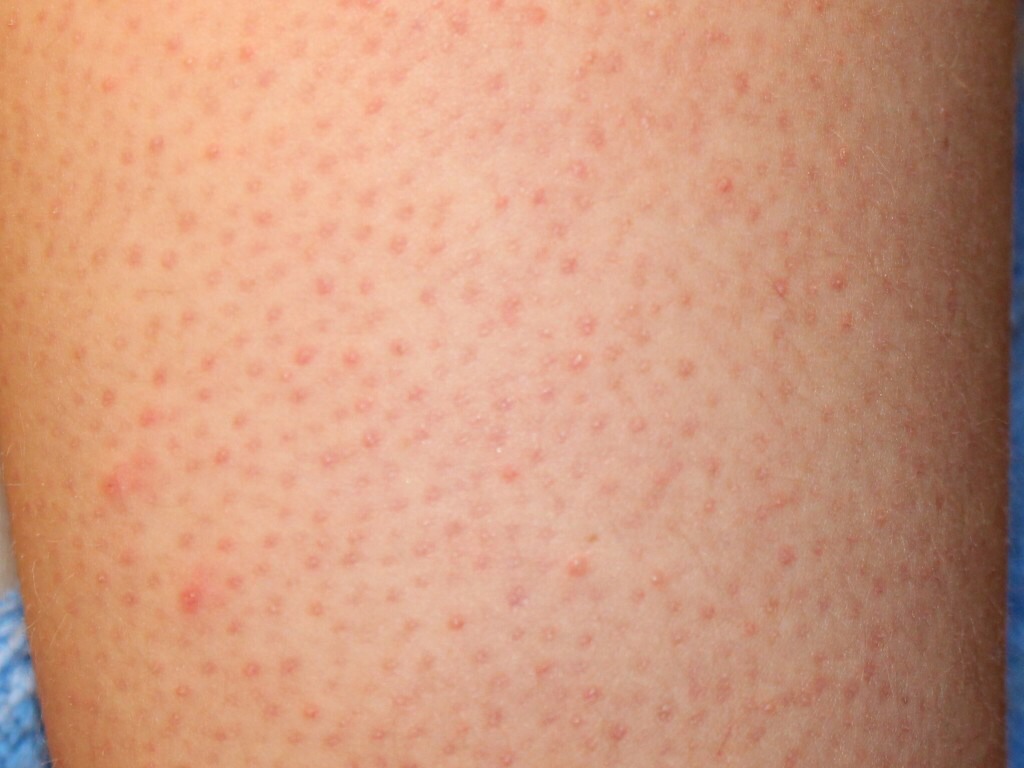 How To Improve Chicken Skin Keratosis Pilaris Trusper How To Improve Chicken Skin Keratosis Pilaris Trusper