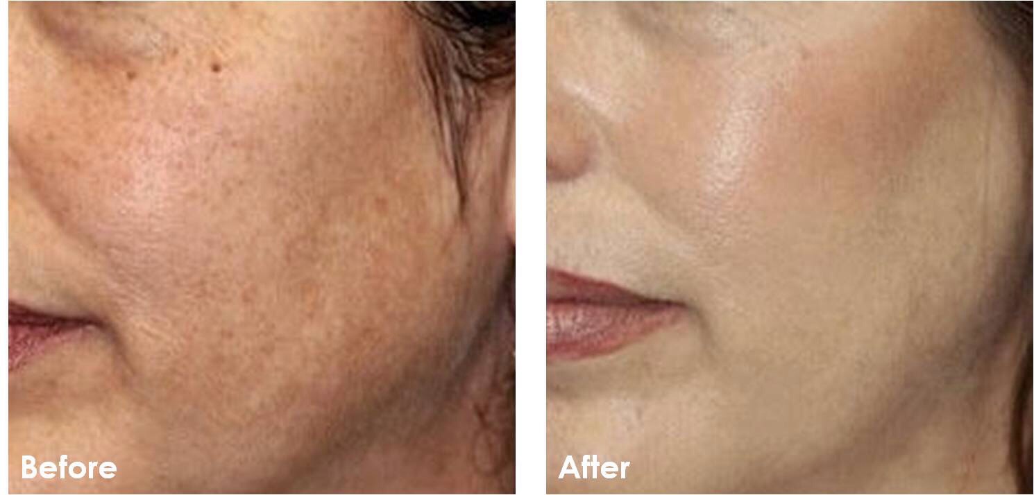 TCA Peel Tutorial Trusper TCA Peel Tutorial Trusper