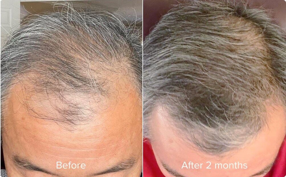 Rx Minoxidil Oral Medication For Hair Regrowth - Male Baldness ...