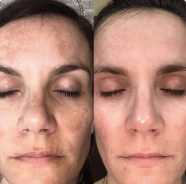 Dark Spot Corrector/Remover - Hydroquinone Cream for Melasma - The Spot ...