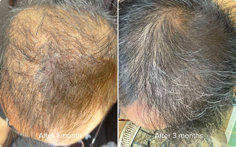Rx Minoxidil Oral Medication For Hair Regrowth - Male Baldness ...