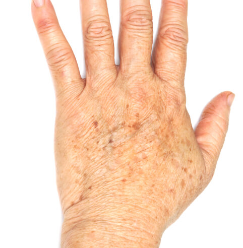 Dark Spot And Anti-Aging Body Cream - Hydroquinone And Tretinoin ...