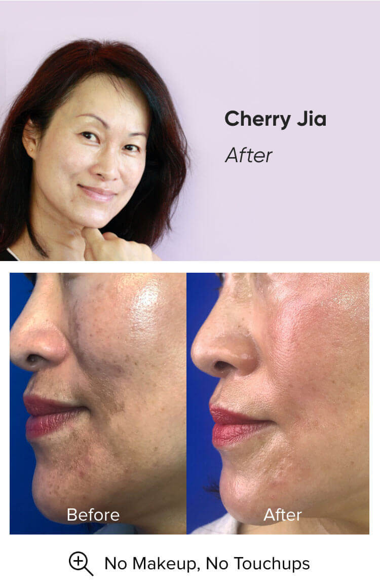 20 Years Of Melasma Gone In 4 Weeks | Musely FaceRx Story