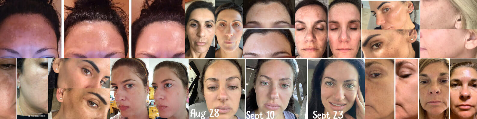 20 Years Of Melasma Gone In 4 Weeks | Musely FaceRx Story