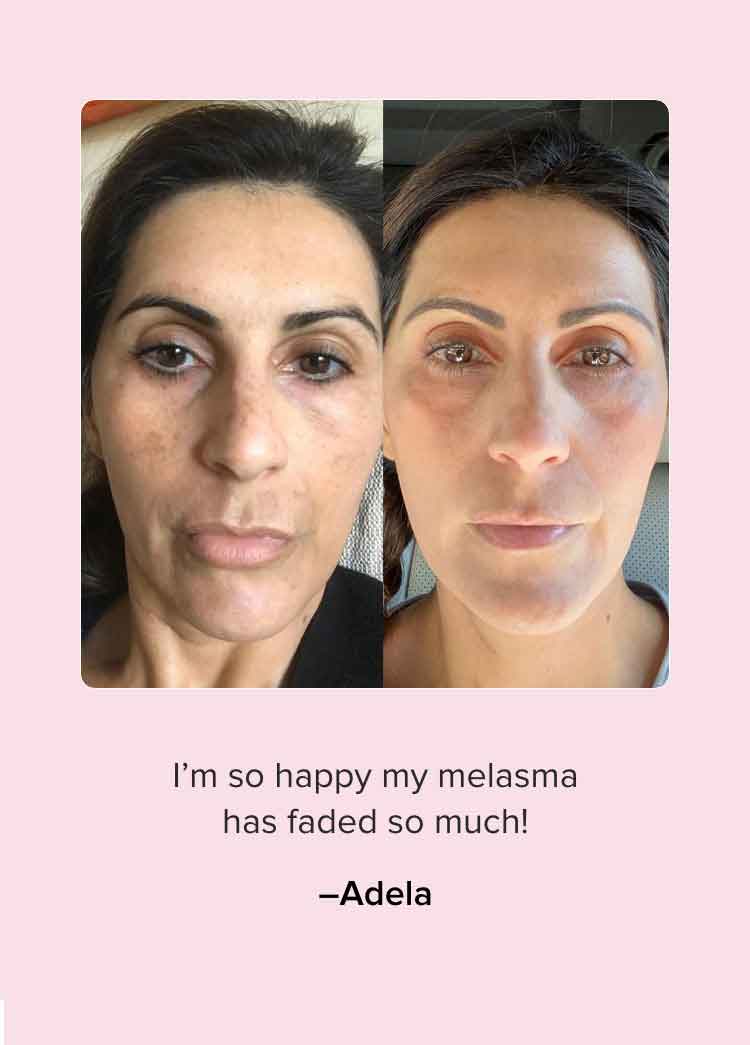 20 Years Of Melasma Gone In 4 Weeks | Musely FaceRx Story