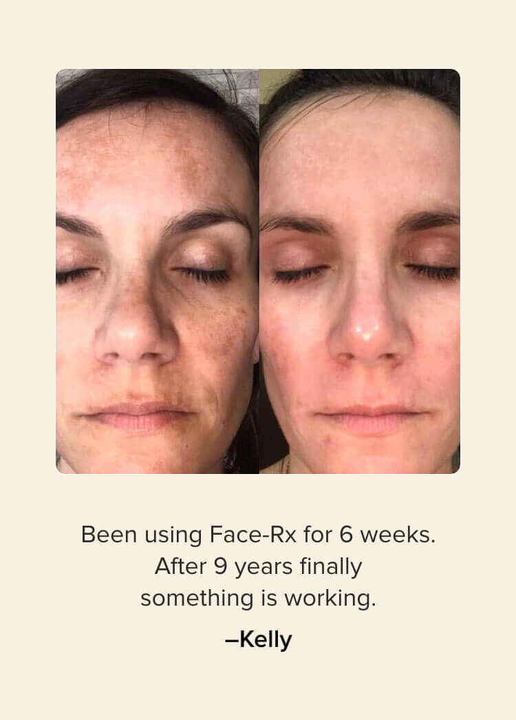 20 Years Of Melasma Gone In 4 Weeks | Musely FaceRx Story