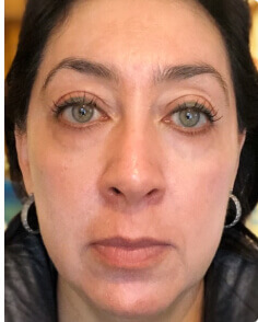 The Spot Pill | Dark Spot Remover | Tranexamic Acid for Melasma