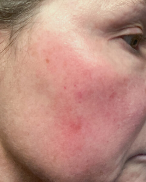 Rosacea Redness Treatment | Metronidazole Cream | The Red Set