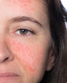 Rosacea Medications | Quick Redness & Flushing Relief | The Red Rescue