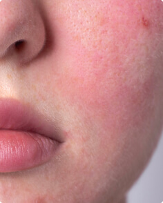 Rosacea Medications | Quick Redness & Flushing Relief | The Red Rescue