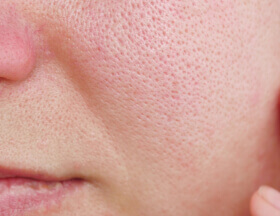 Rosacea Treatment | Facial Hair Removal | Anti-Aging Cream | Musely